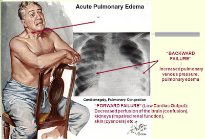 Medicina y Melodía: Cuando nos falta el aire: Disnea