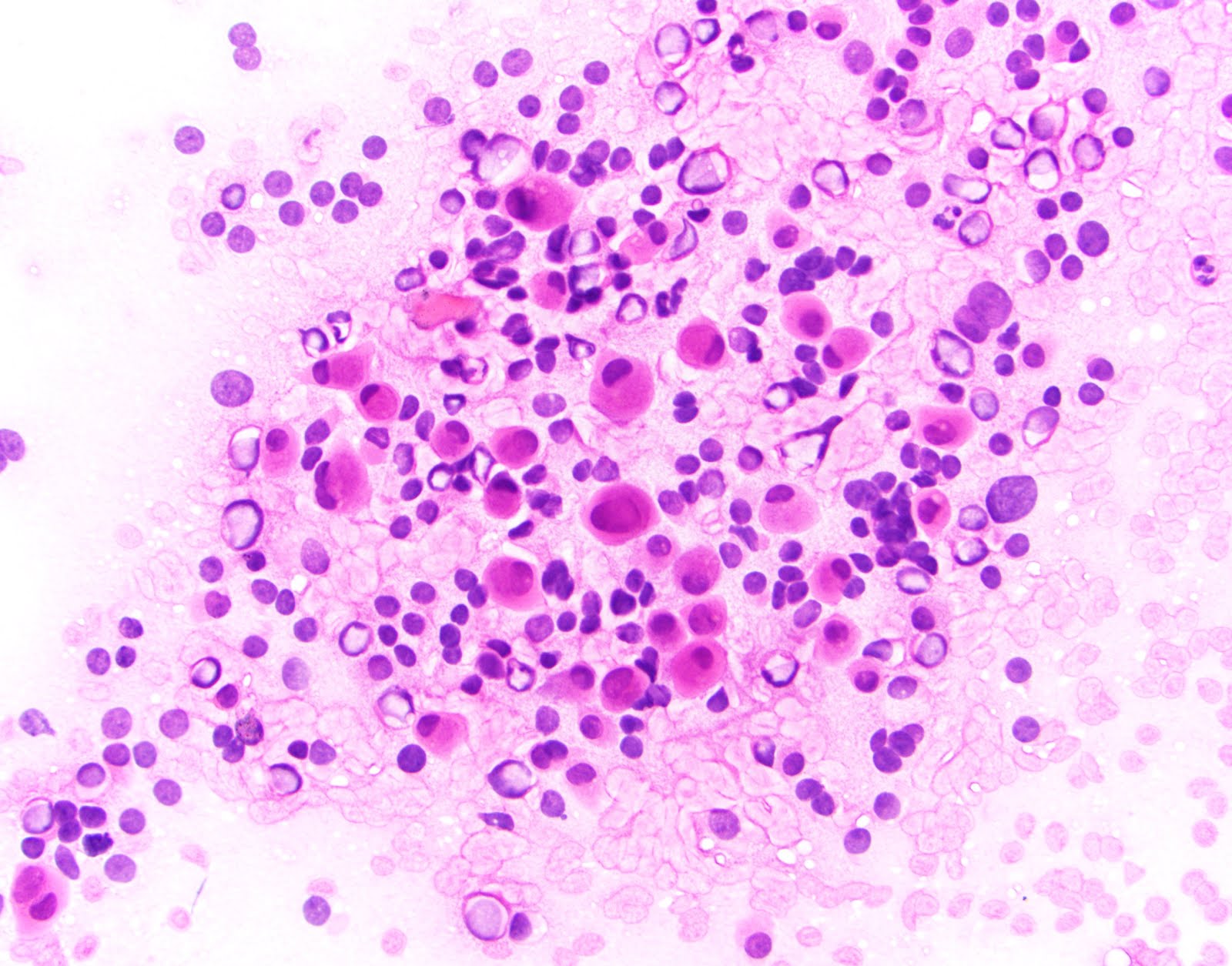 neuropathology blog: Crooke cells in a touch preparation of a ...