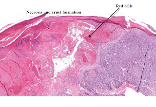 Dermatopathology Made Simple - Inflammatory: Pustular Reaction Pattern