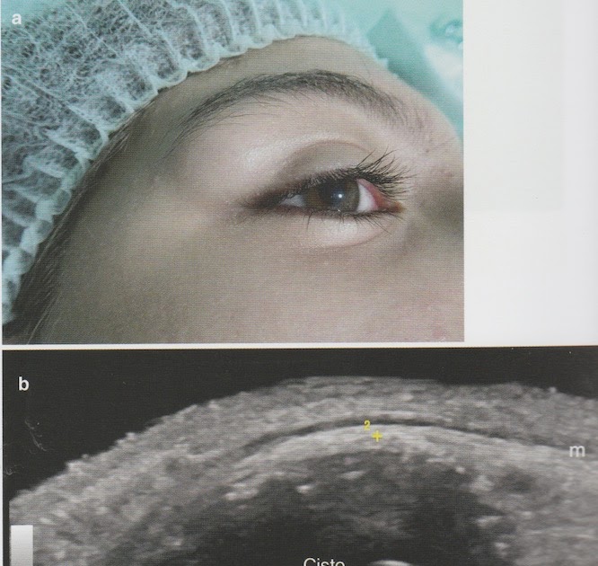 Referências Radiológicas: Cisto Dermoide