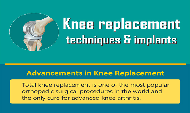 Knee Replacement Techniques and Implants #infographic - Visualistan
