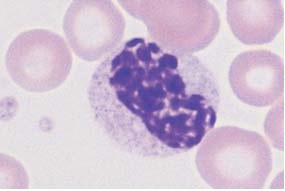 [Haematology] Abnormalities of the White Cell Series | Free Medical Atlas