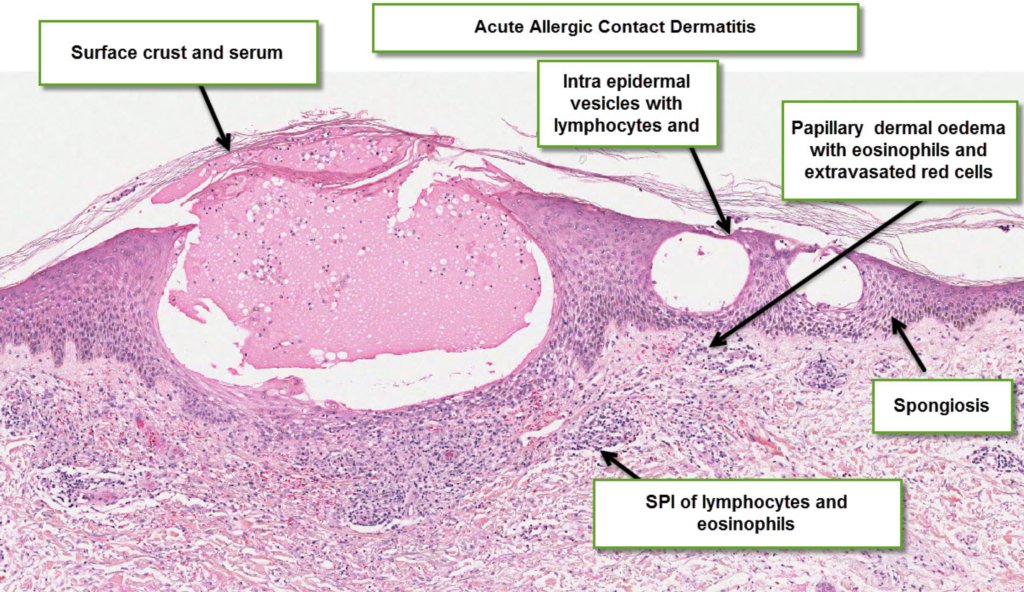 Dermatopathology Made Simple - Inflammatory: Vesicles or Blisters