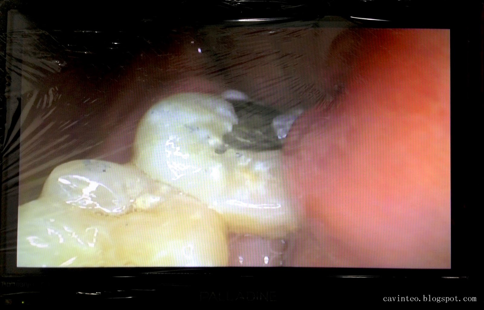 Entree Kibbles: Food Stuck In Between Teeth? Time to Visit a Dentist ...