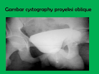 DERAMA: RETROGRADE CYSTOGRAPHY ( CYSTOGRAM)