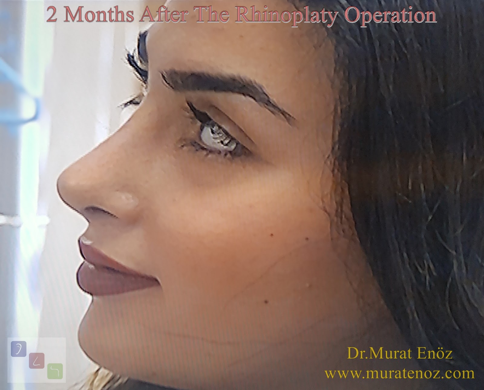 Functional Rhinoplasty Operation in Istanbul