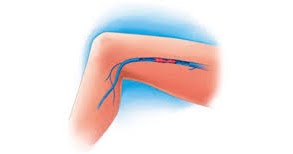 Tratamento da flebite