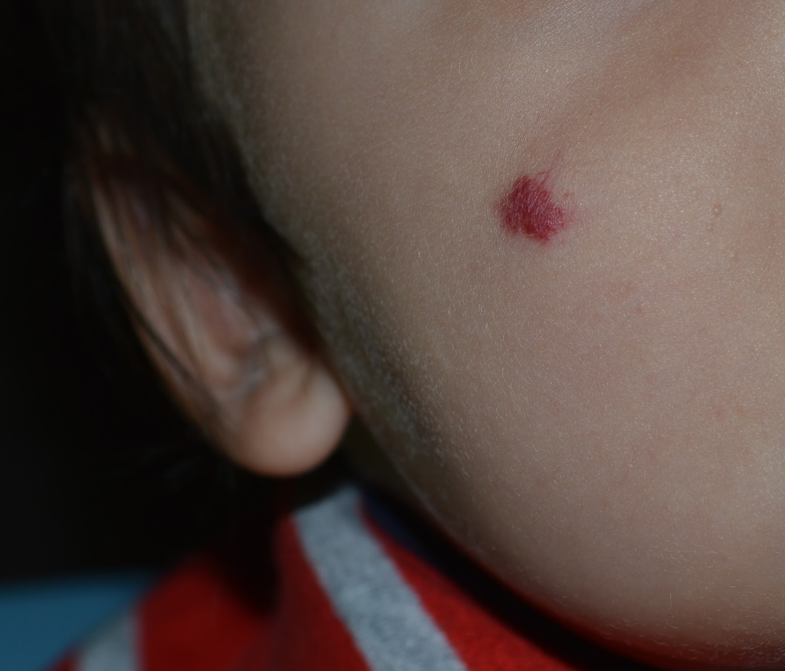 I Love Noah: Strawberry Birthmark