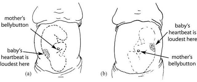 松下 ER ランチ・カンファレンス: 胎児心音