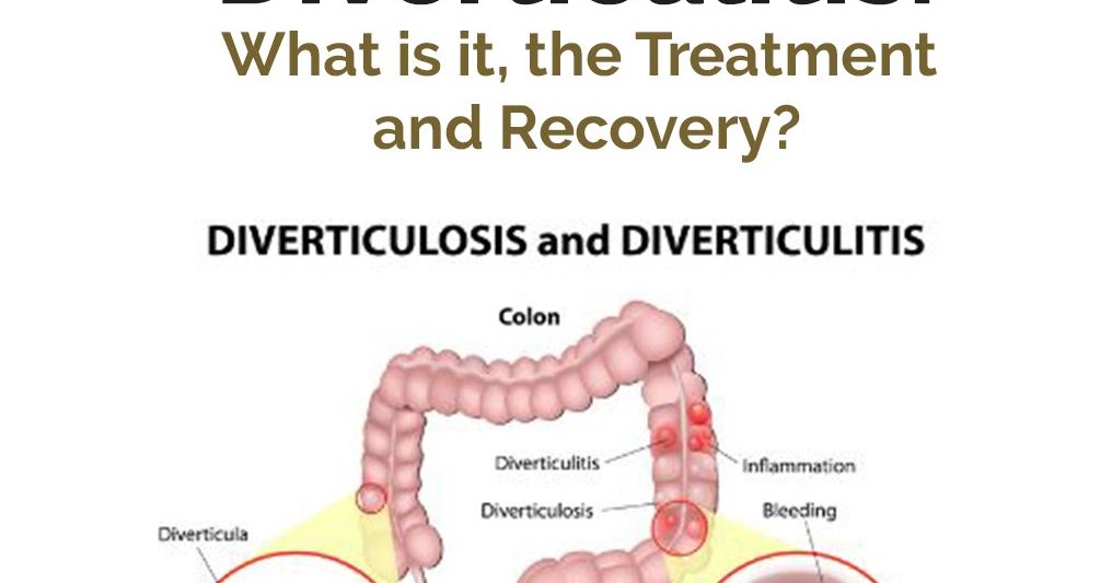Diverticulitis: What is it, the Treatment and Recovery?