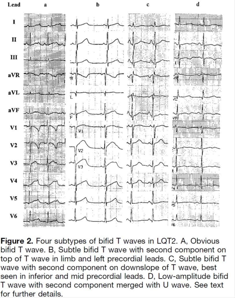 Pedi cardiology: LQTS - Type Recognition by T wave Morphology