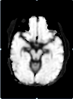 pediatric neurology: The consequence of a reversal sign
