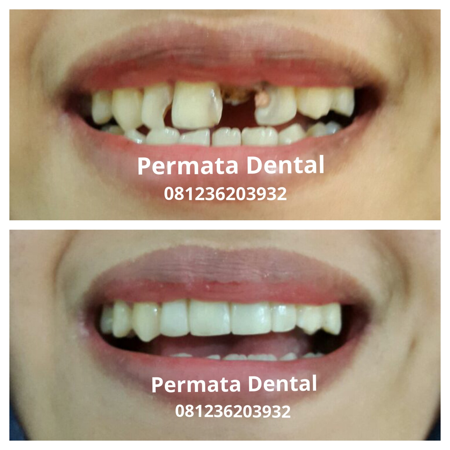 DOKTER GIGI BALI: Veneer Gigi | Samsung Gigi