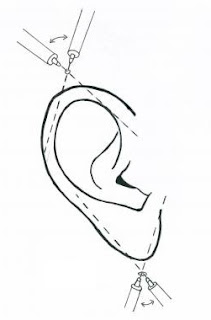 Medical-Review: Ear Anesthesia