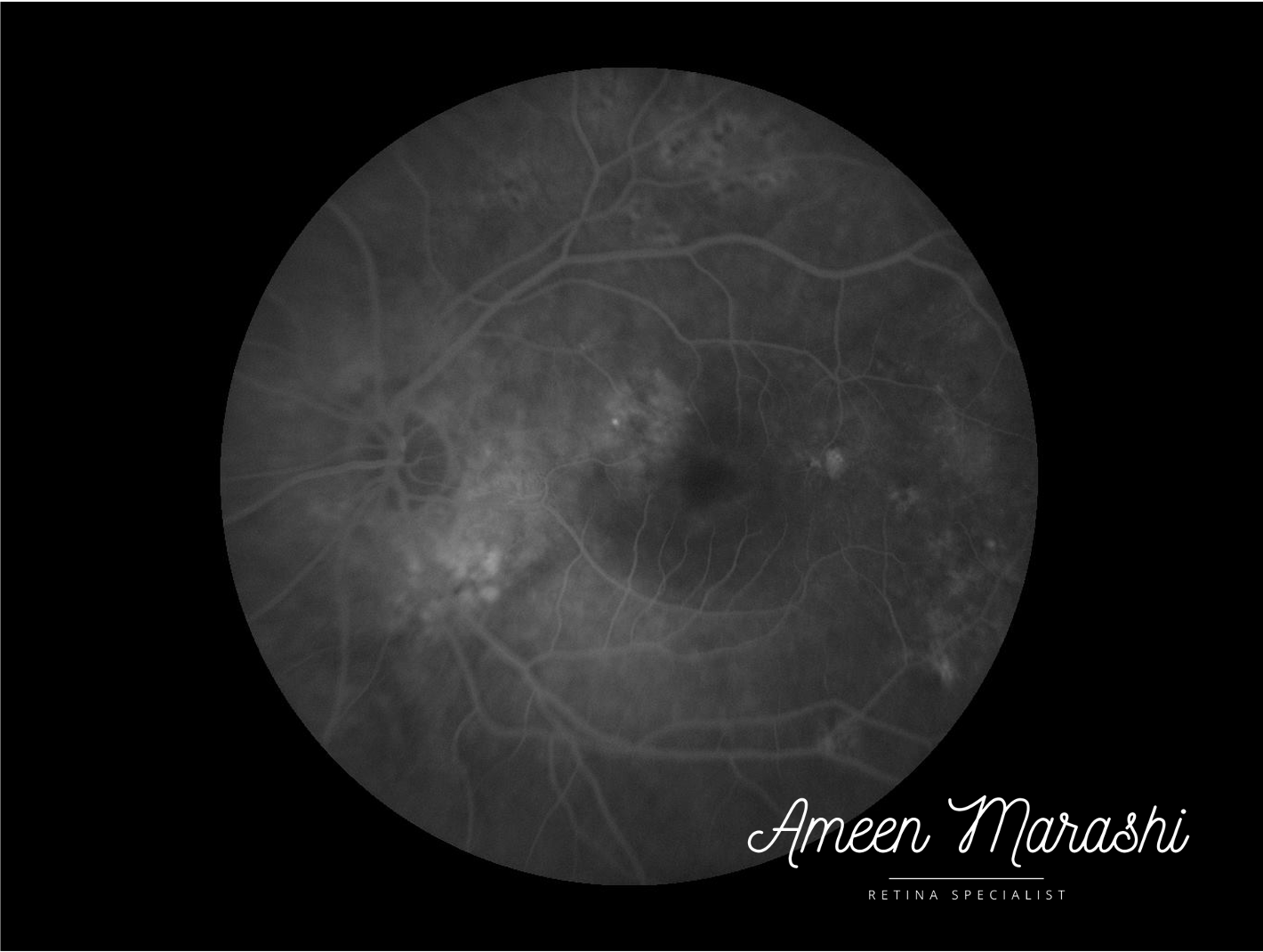 Chronic Central Serous Chorioretinopathy fundus image, OCT and FFA in a ...