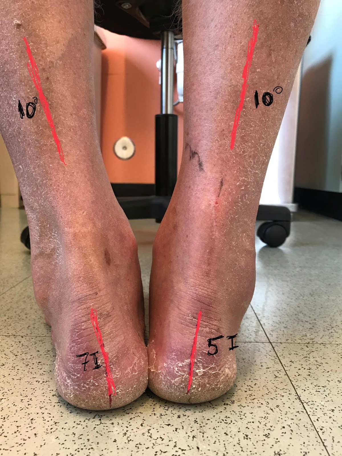 Foot And Ankle Problems By Dr Richard Blake The Inverted Foot What To Do
