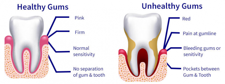 Reverse Periodontal Disease