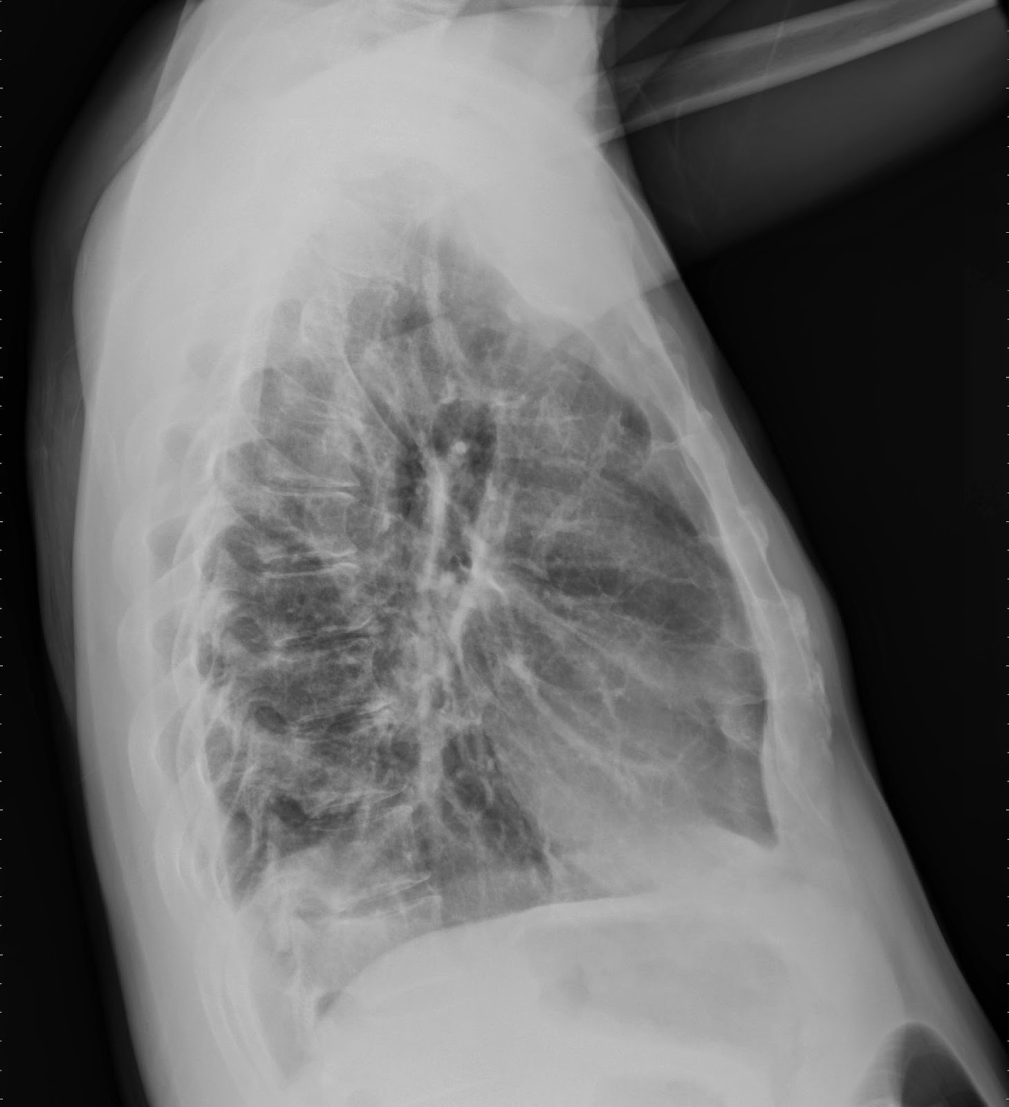 CXR 胸部x光判讀 right lower lobe (RLL) and right middle lobe (RML) collapse