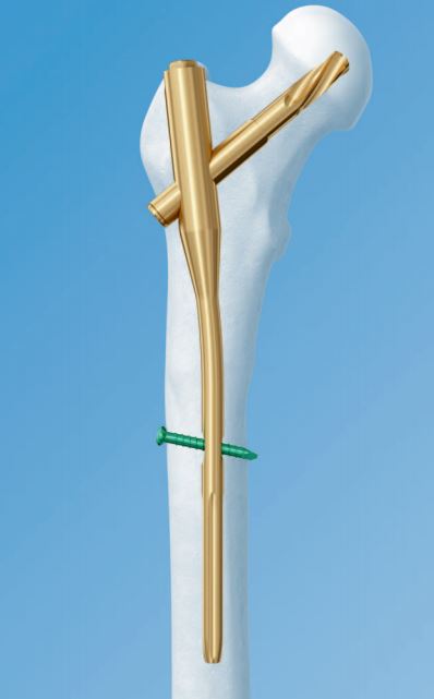 PFN PFNA PFNA2 TFN differences and features