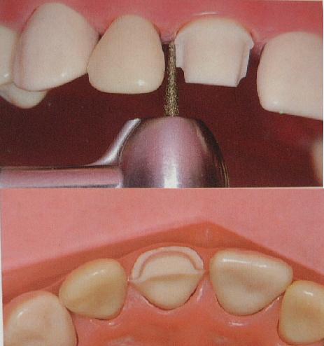 Dentistry lectures for MFDS/MJDF/NBDE/ORE: A note on Jacket crowns ...