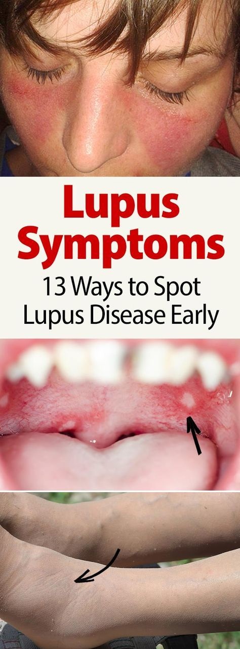 Lupus Symptoms: 13 Ways to Spot Lupus Disease Early - wellness magazine