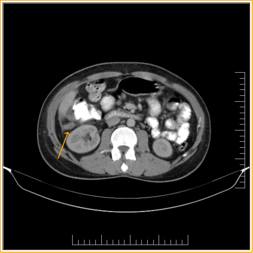 Appendicitis complicated with Subphrenic Abscess - Sumer's Radiology Blog