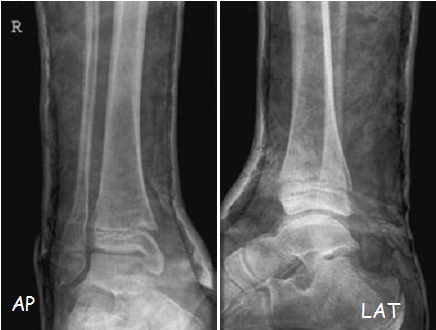 Teknik pemeriksaan radiology pada kasus post trauma ankle / pasang gips ...