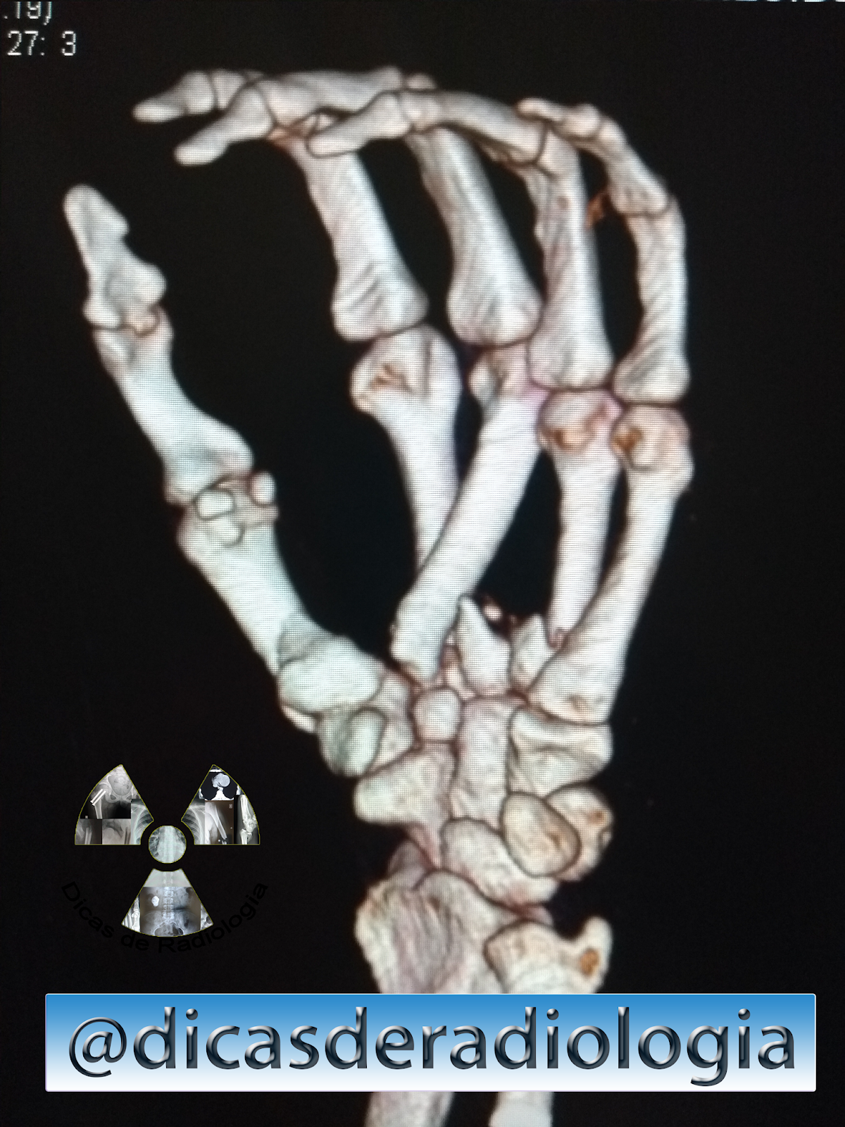 DICAS DE RADIOLOGIA: IMAGENS RADIOLÓGICAS DEMONSTRANDO FRATURA DA BASE ...