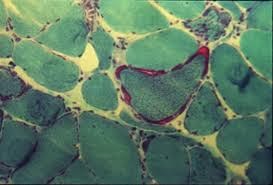 Medical Treatment Pictures-for Better Understanding: MELAS Syndrome