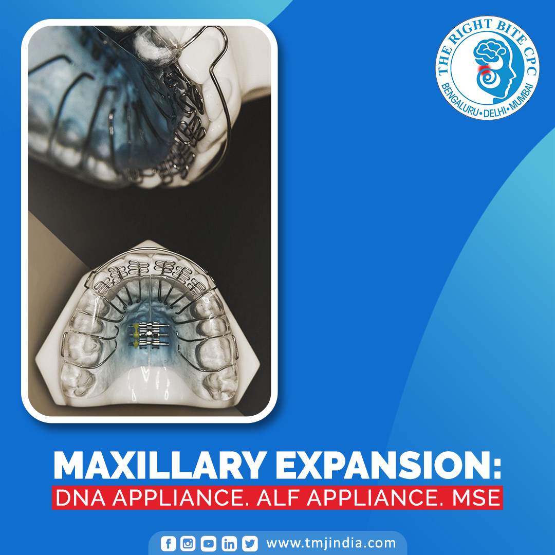 Treatment For TMJ Disorders: Maxillary Expansion: DNA appliance. ALF ...