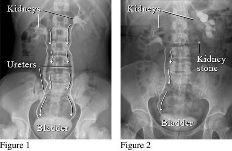 Pemeriksaan Radiologis Penyakit GINJAL | Ilmu Kesehatan Medis