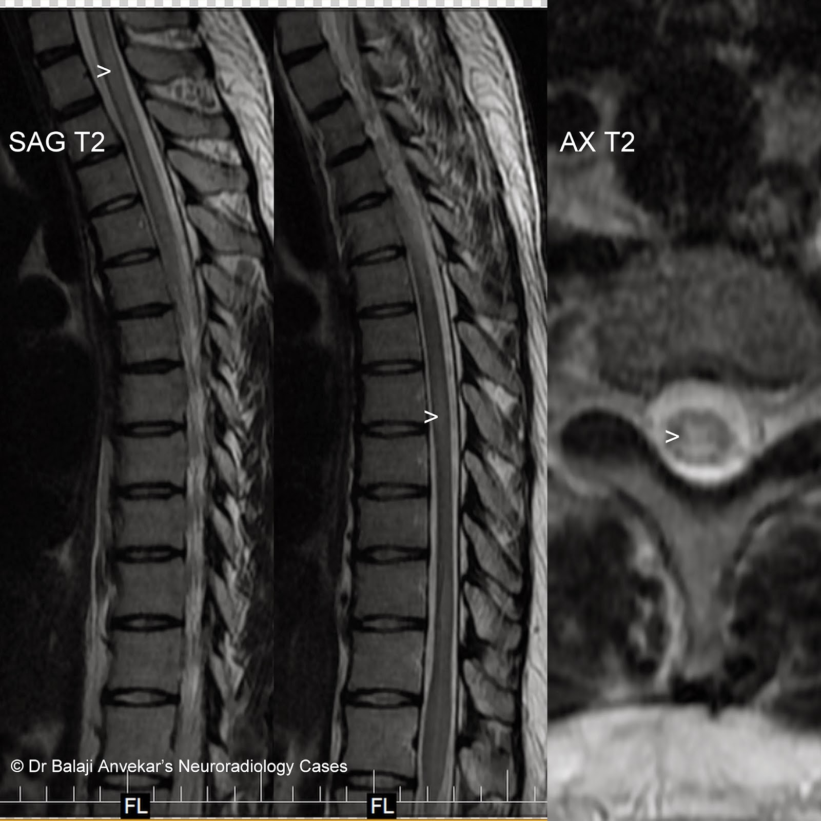 Dr Balaji Anvekar FRCR: Transverse Myelitis MRI