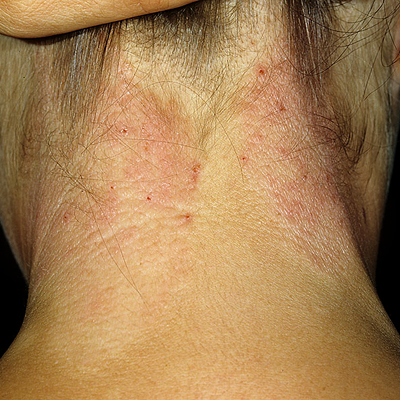 Neuronas enlatadas: ¿Qué es eso? La neurodermatitis