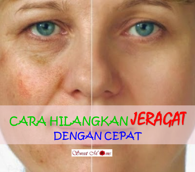 Bagaimana Cara Nak Hilangkan Jeragat Dengan Cepat Dan Berkesan ...