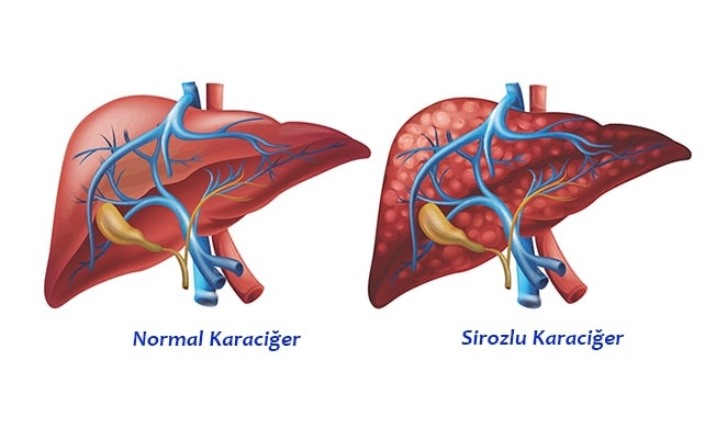 Siroz hastalığı nedir? Nasıl ilerler ve nasıl tedavi edilir?