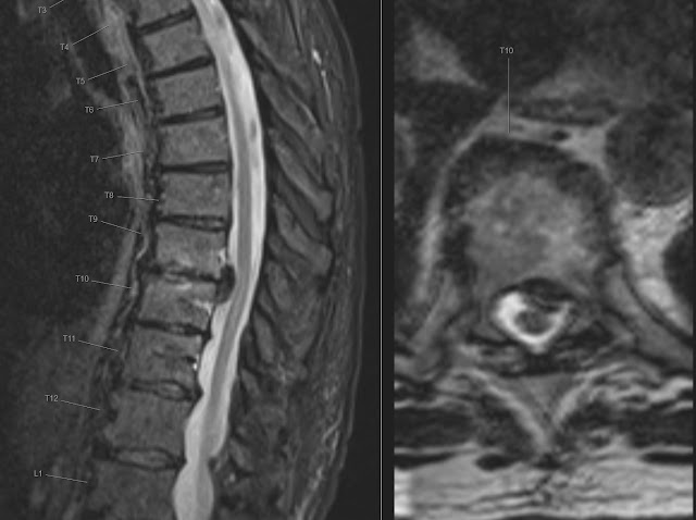 Calcified Thoracic Disc Herniation