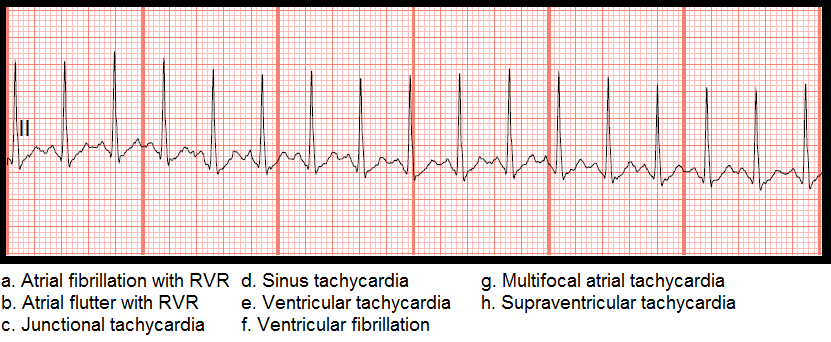 Fast Heart Rhythm Quiz 295