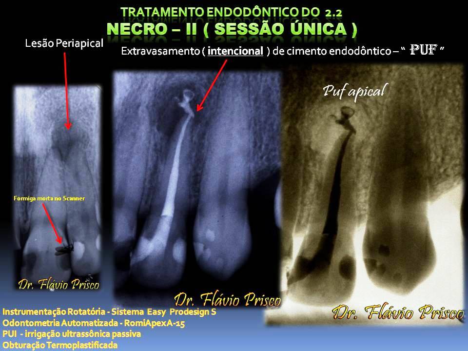 Descobrindo e explorando a Endodontia : Surplus ( " puff " )