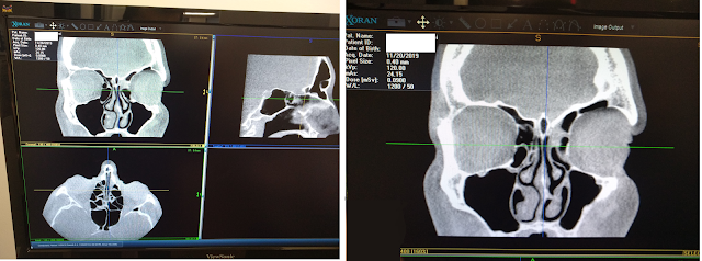 Septoplasty - чиним носовую перегородку.