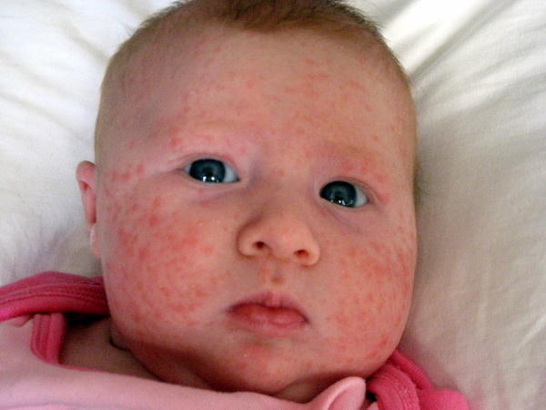 Baby pimples, baby acne - causes and how to get rid these problems ...