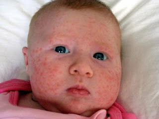 Baby pimples, baby acne - causes and how to get rid these problems ...