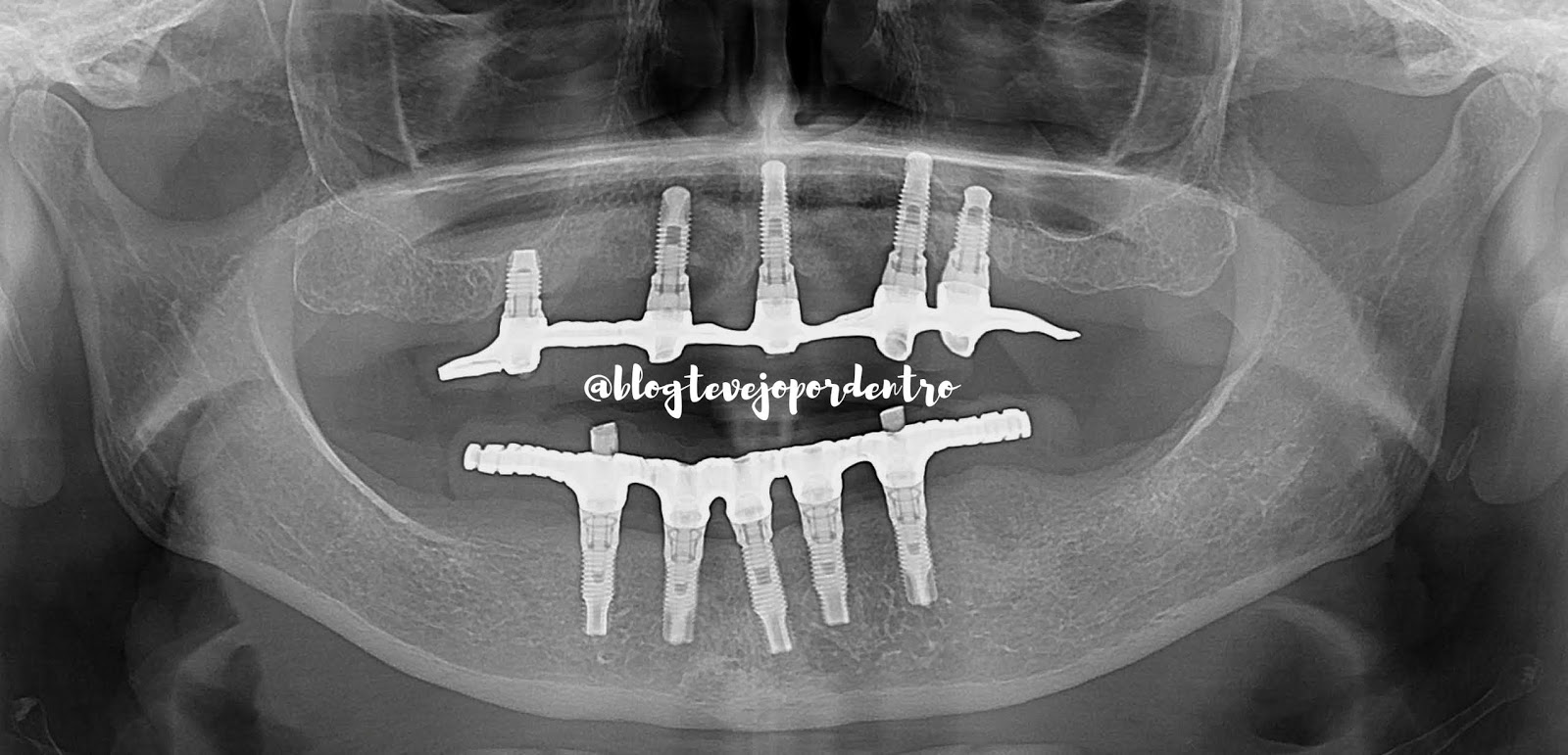 "Te vejo por dentro": Radiografia para controle de implantes