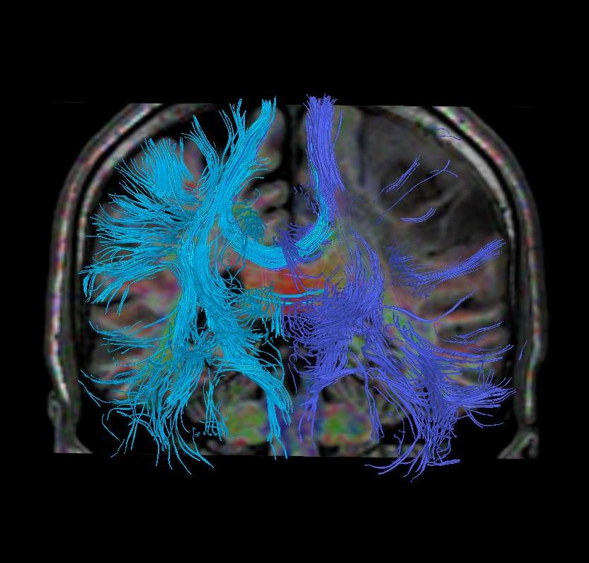 Fiber Tracking-MRI - Sumer's Radiology Blog