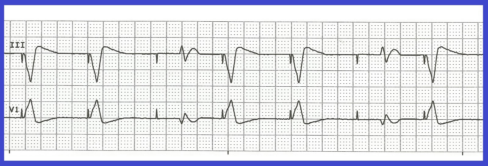 Basic EKG Rhythm Test 11
