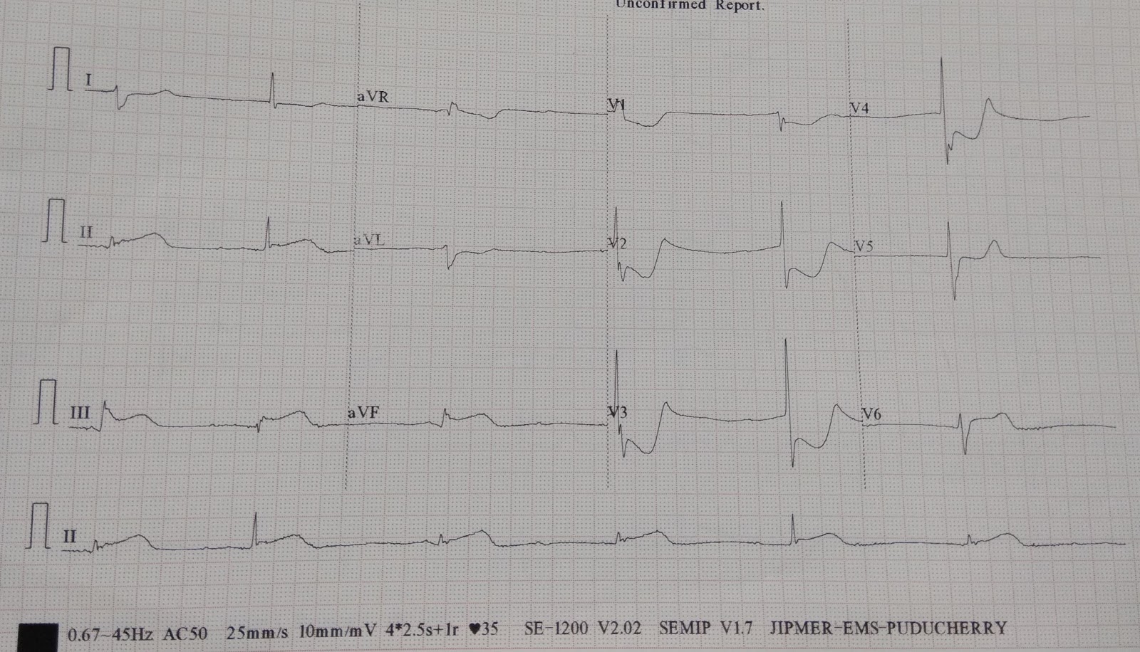 Cardiology window: Posterior wall myocardial infarction with inferior ...