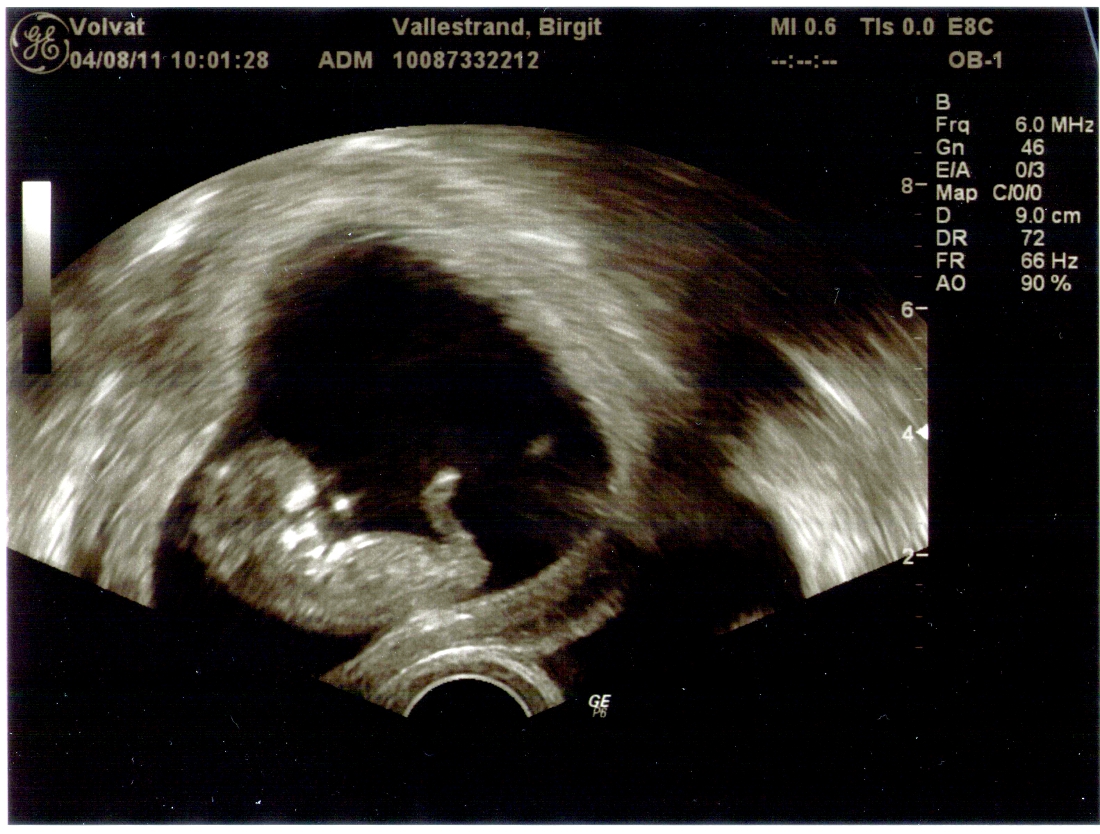 My Baby Bump: Scans