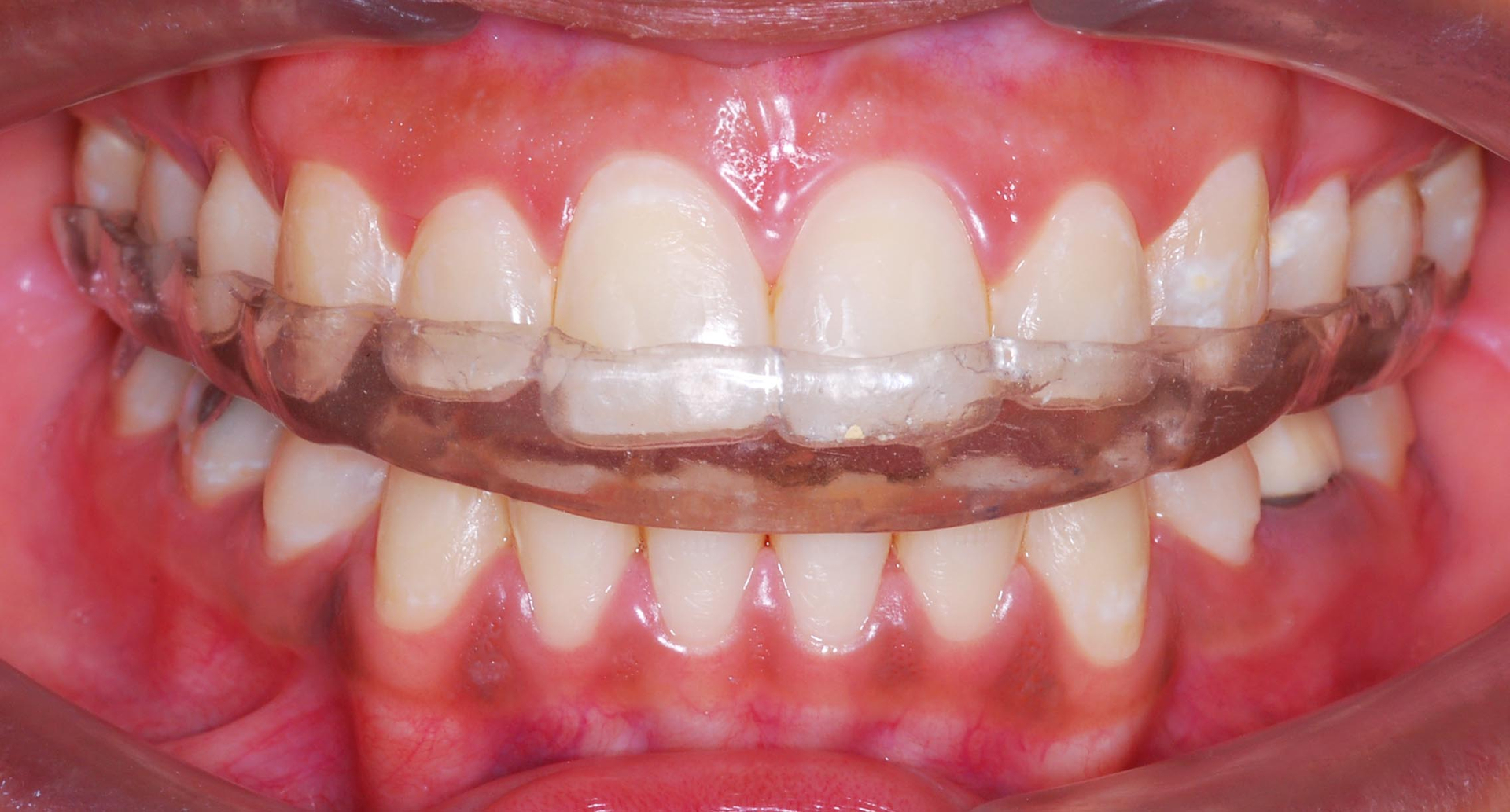 ¿Sirve protector bucal deportivo (sport mouth guard) para rechinamiento ...