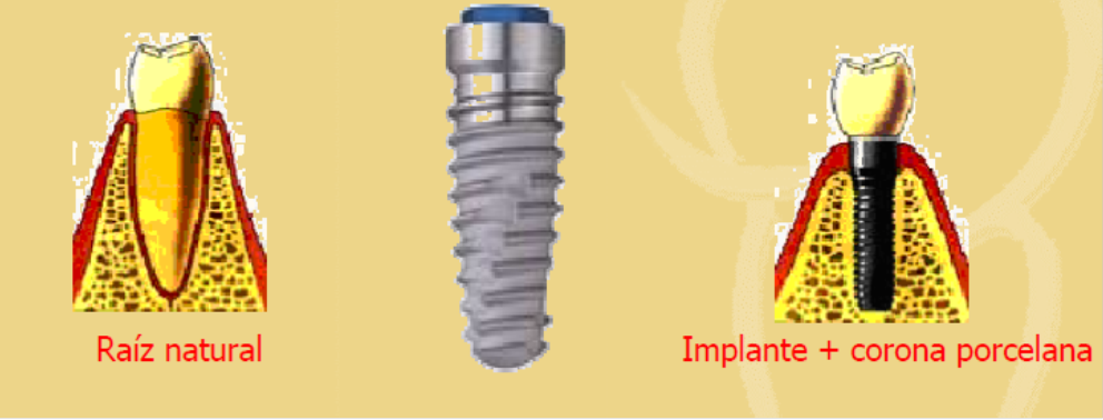 Implantología oral: IMPLANTOLOGÍA ORAL