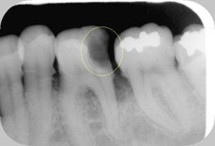 RADIOLOGIA DE LA CARIES DENTAL