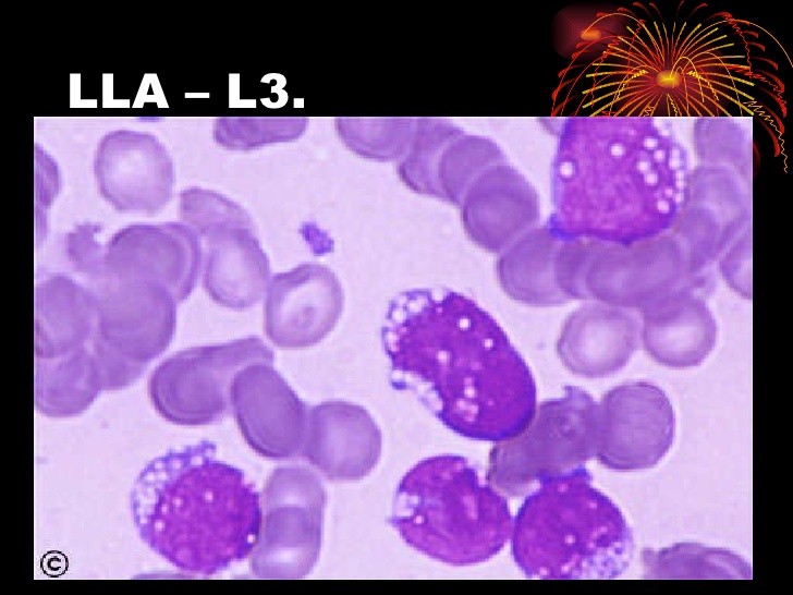 Hematología Fichas: Leucemia Linfocitica Aguda (L -3), Hematología Fichas: Leucemia Linfocitica Aguda (L -3),